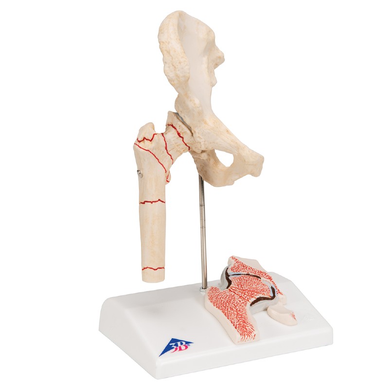 Hip Model w/ Fracture and Osteoarthritis | Health and Care